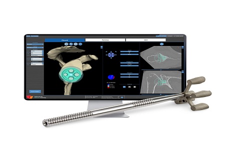 Stryker introduces Tornier Shoulder Arthroplasty Portfolio in India